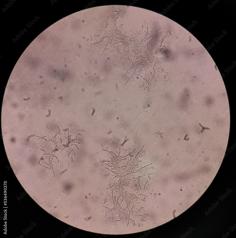 Microscopic fungi Malassezia furfur, showing yeast cells and hyphae ...