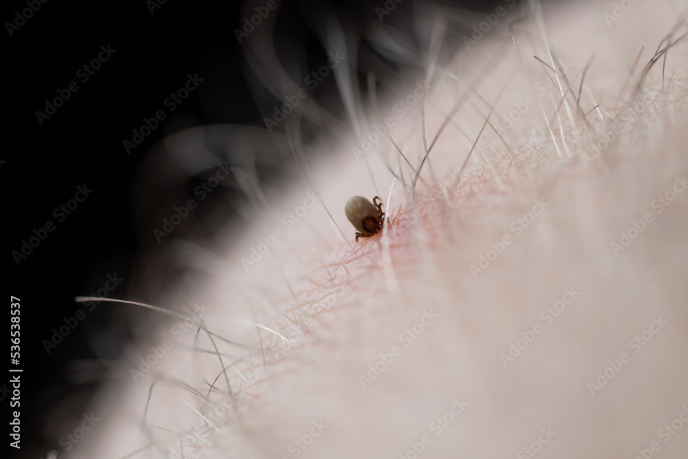 Tic with head sticking into human skin, red spots indicate infection ...