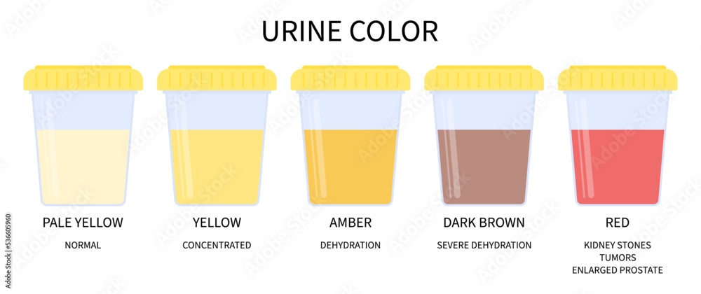 Vetor de color of urination microscopic diagnostic exam the renal ...