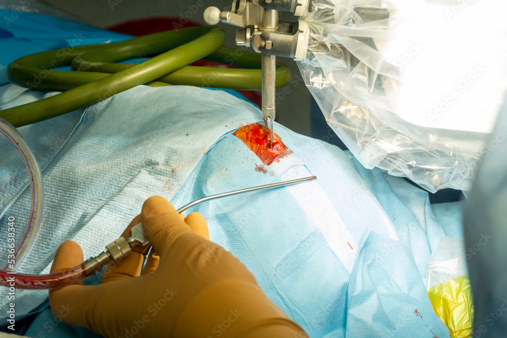 Step by step Visualase is an MRI-guided laser ablation system used to ...