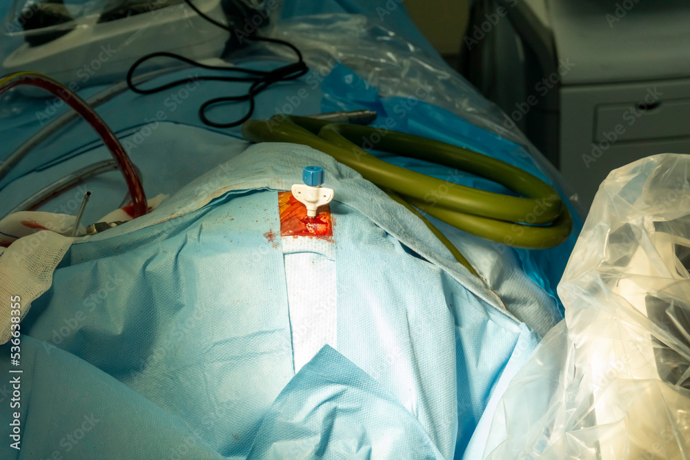 Step by step Visualase is an MRI-guided laser ablation system used to ...