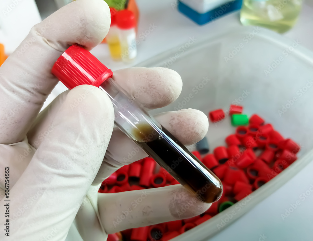 Biochemist hold red Pleural fluid sample with laboratory background ...