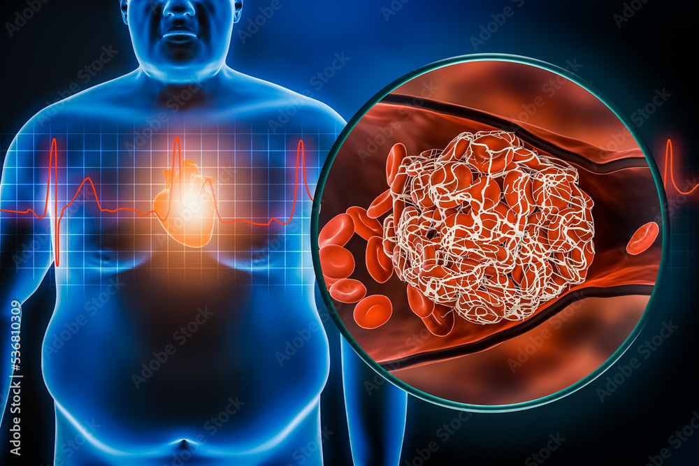 Illustrazione Stock Heart attack or stroke 3D rendering illustration ...