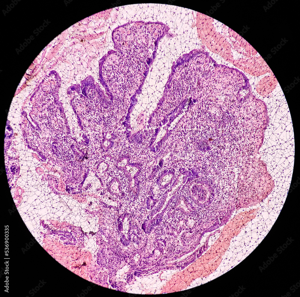 Tissue from gastro-jejunostomy stomal site (endoscopic biopsy): Chronic ...