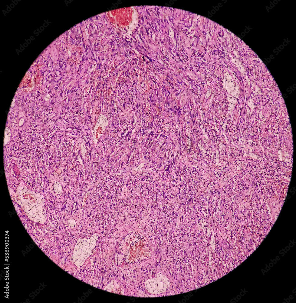 Small intestine mass(biopsy): Malignant gastrointestinal stromal tumor ...