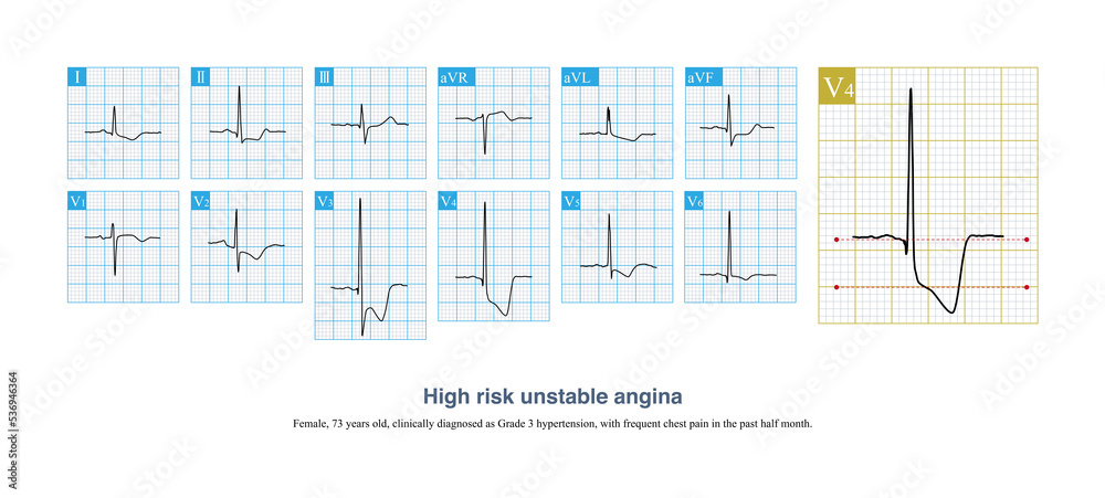 When a clockwise rotation of the basic ECG, the corresponding accuracy ...