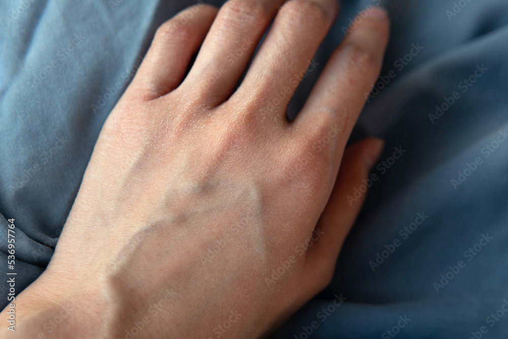 Closeup Dry irritated thin skin adults woman’s palm or back of the hand ...