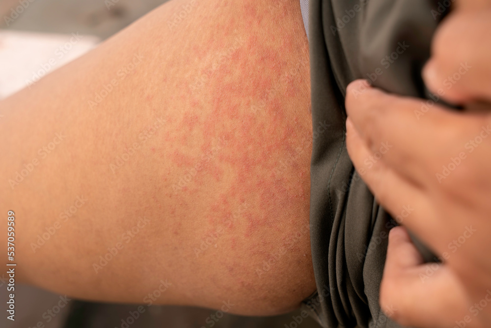Dermatitis A red rash that occurs on the skin. Stock Photo | Adobe Stock