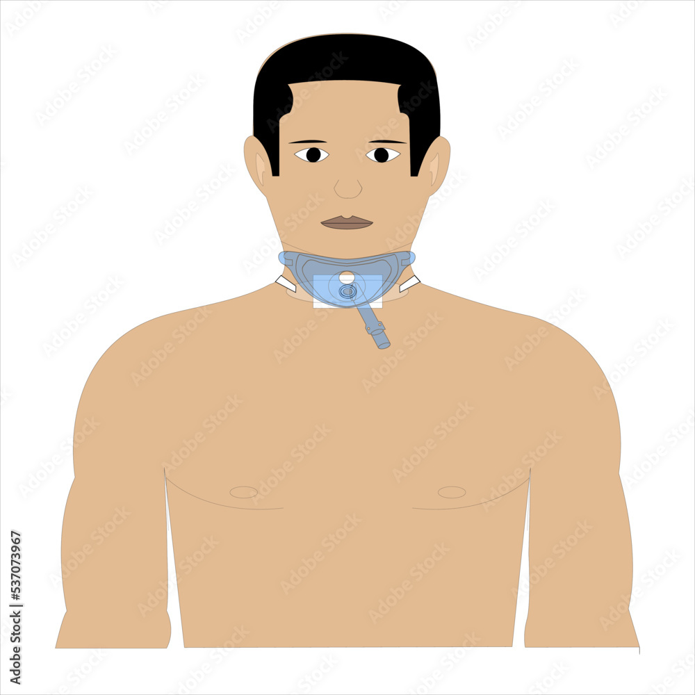 Paciente con traqueostomo y mascara de traqueostomia vista frontal ...