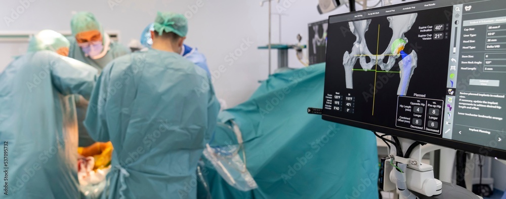 Team of doctor perform total hip arthroplasty replacement surgery in ...