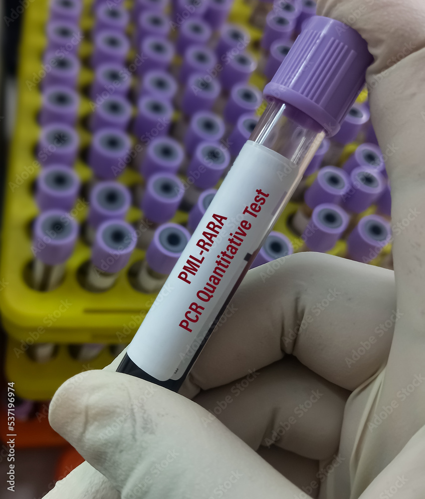 Blood sample for PML-RARA quantitative test in PCR laboratory. Acute ...