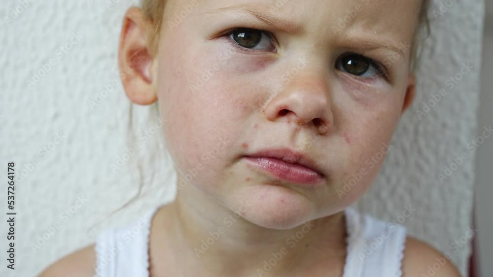 Enterovirus Leg - arm - mouth. Rash on the body of a child. Cocksackie ...