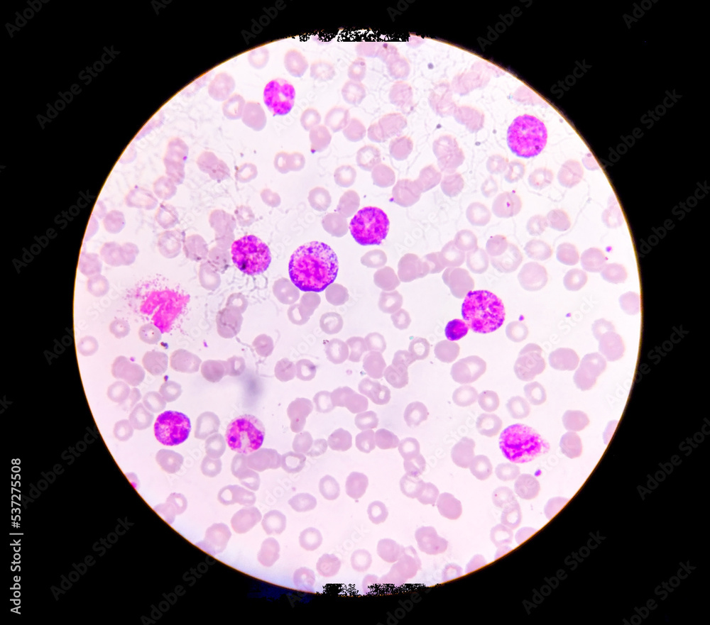 Acute myeloid leukemia (AML) is a type of blood cancer. Microscopic ...