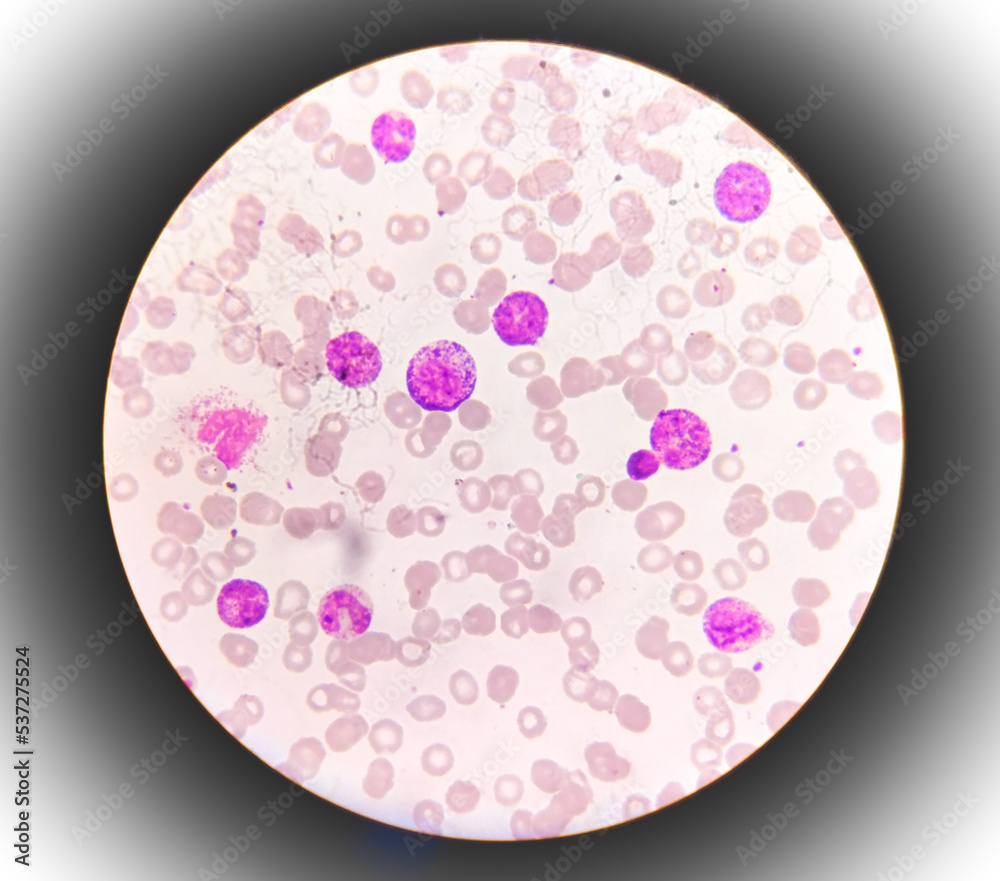 Acute myeloid leukemia (AML) is a type of blood cancer. Microscopic ...