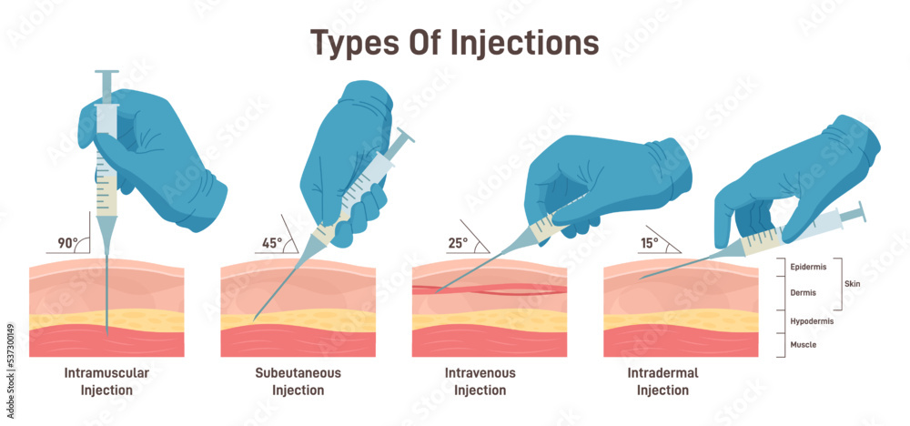 Diagram Showing Intramuscular Injection Illustration - vrogue.co Diagram Showing Intramuscular Injection Illustration - vrogue.co