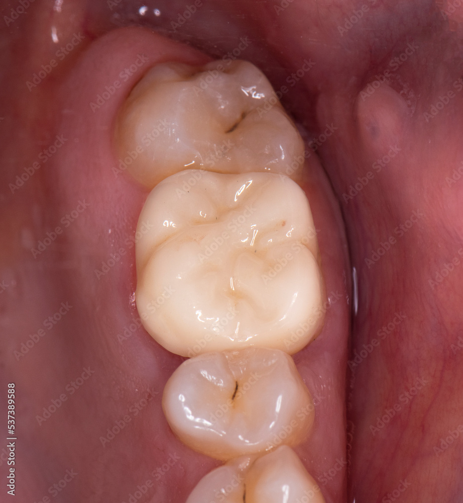 replacing old metal ceramic crown with new full ceramic crown Stock ...