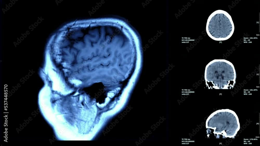 Magnetic resonance imaging MRI brain scan using magnetic field and ...