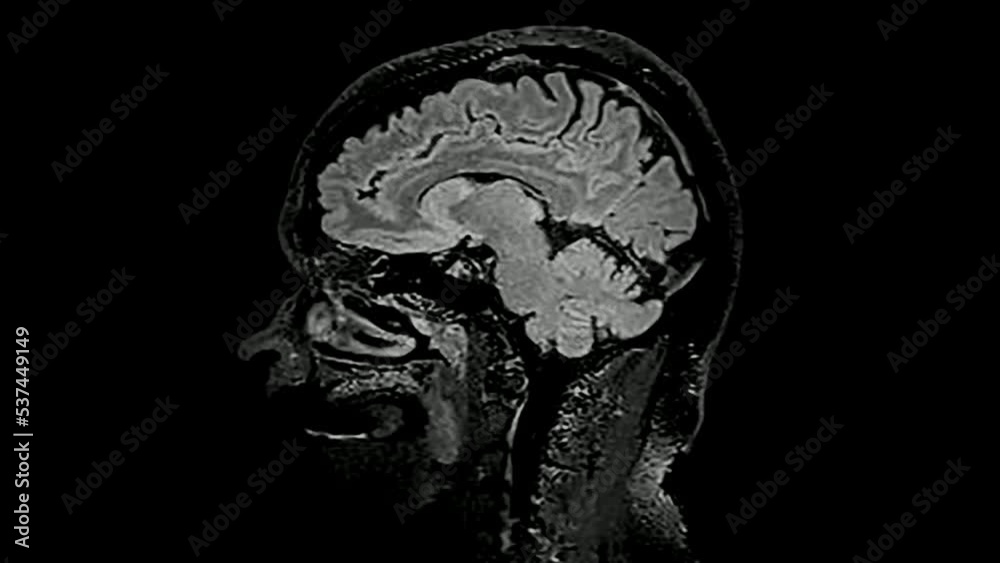 Brain MRI head scans and tumor detection black and white diagram ...