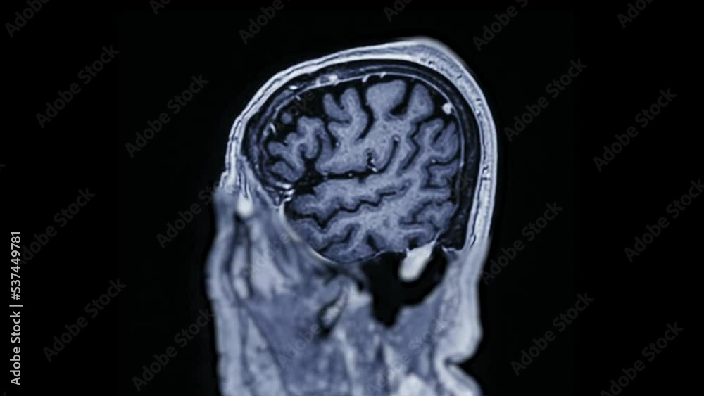 Brain MRI head scans and tumor detection black and white diagram ...