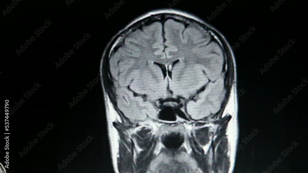 Brain MRI head scans and tumor detection black and white diagram ...