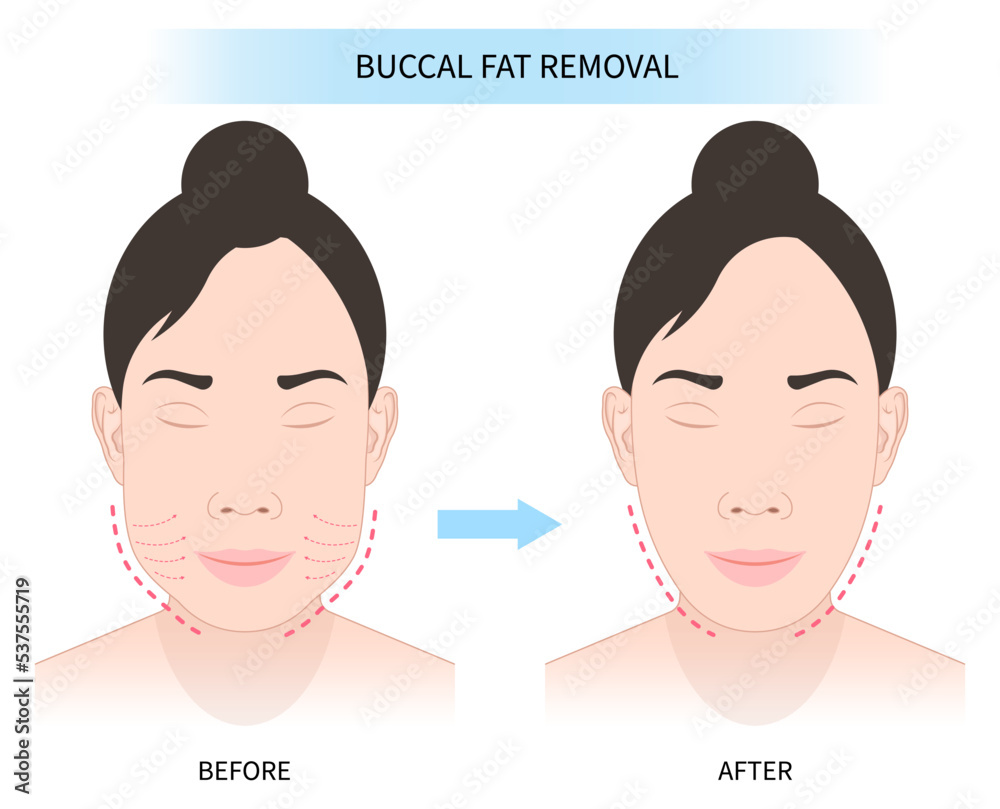Vetor de Before and after Cheek buccal fat removal with augment excess ...