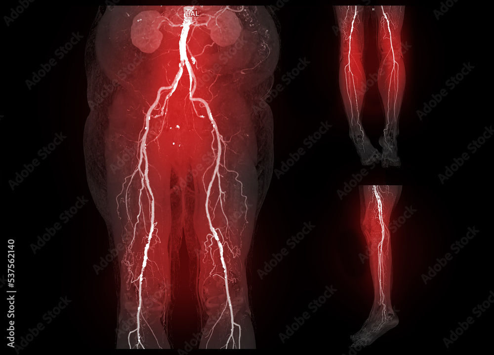 Collection of CT Cardiac 3D or CTA coronary artery for Check up ...