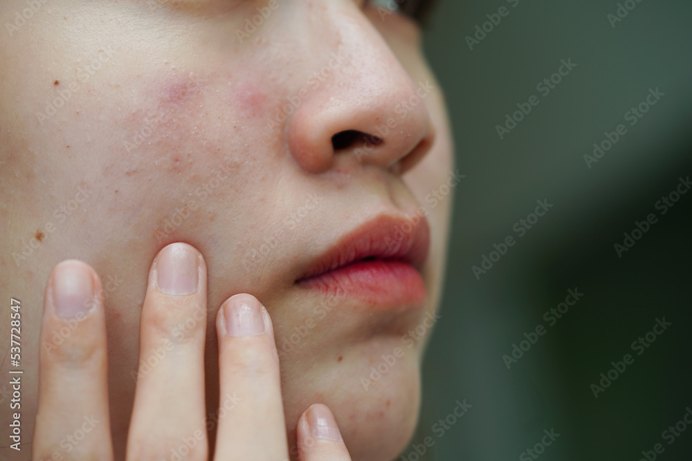 Foto de Acne pimple and scar on skin face, disorders of sebaceous ...