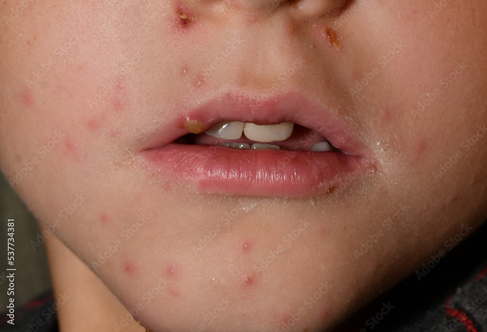 Chickenpox rash on the face of a child. papules around the mouth. Stock ...