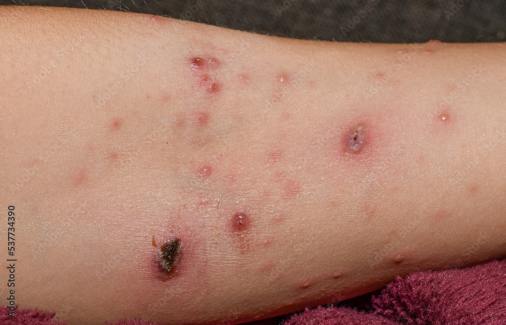 Chickenpox on the body of a child, Severe chicken pox crusts on rashes ...