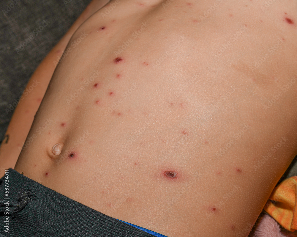 Chickenpox on the body of a child, Severe chicken pox crusts on rashes. papules and blisters ...