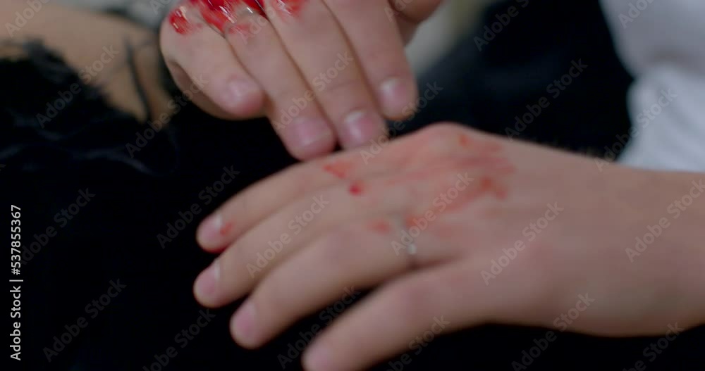 Broken hands of a man after a street fight. He touches the knuckles to ...