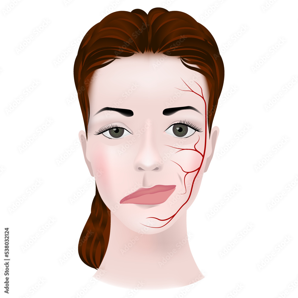 Myasthenia. Woman's twisted face. Damage to the triadic nerve and ...