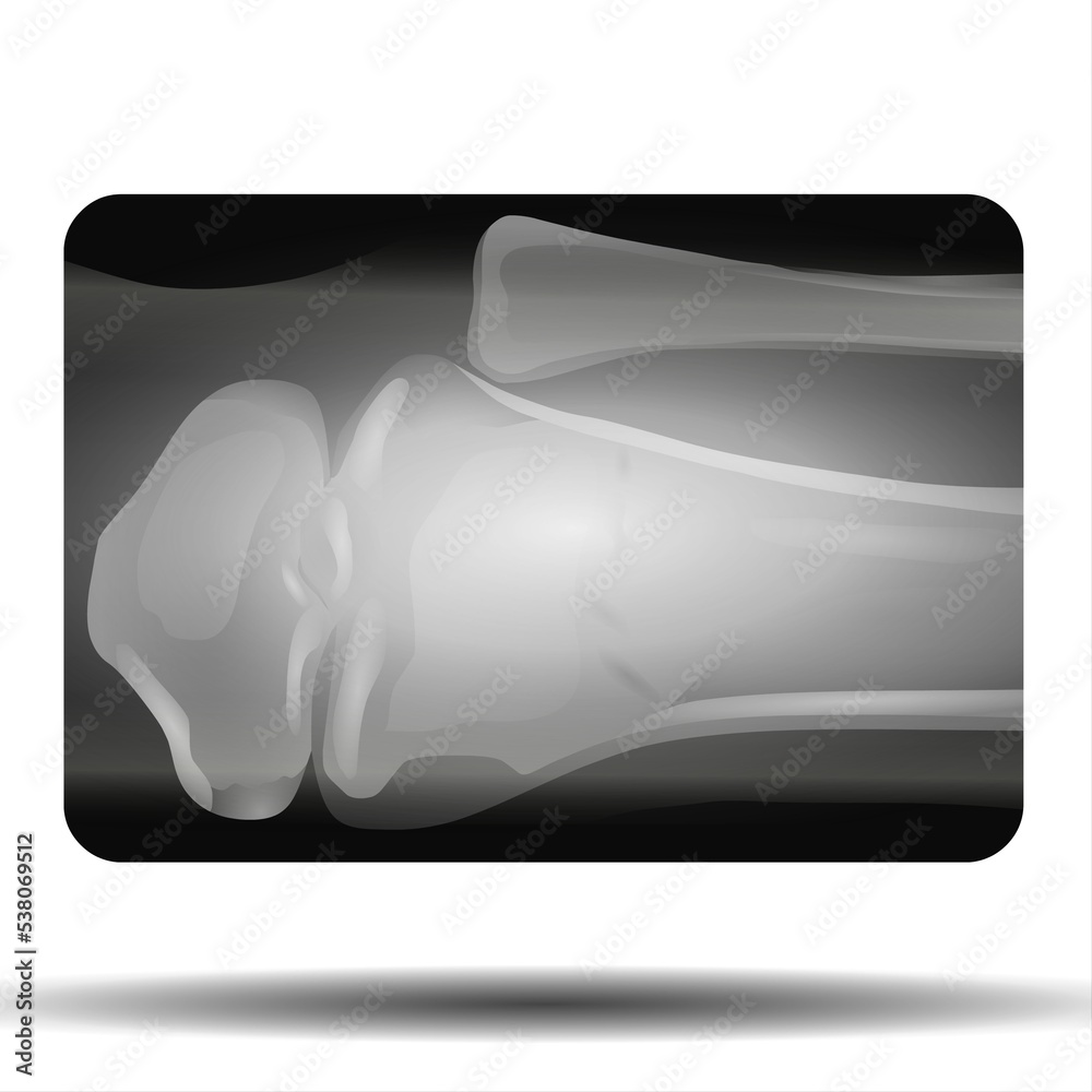 X-ray of the Knee Joint - Fla source file available - X-ray of the knee ...