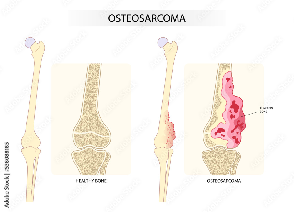 tumor cell with hip femur with The Ewing's sarcoma gross leg bone pain ...