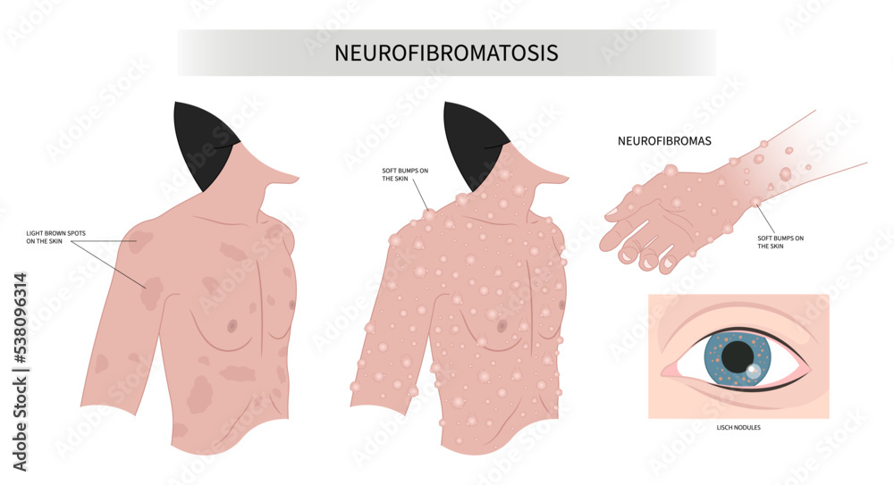 light brown spots on the skin or Neurofibroma spinal cord Freckles ...
