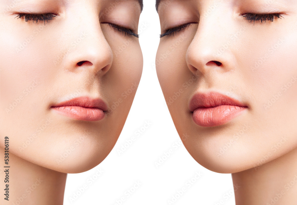Female lips before anf after augmentation procedure. Stock Photo ... Female lips before anf after augmentation procedure. Stock Photo ...