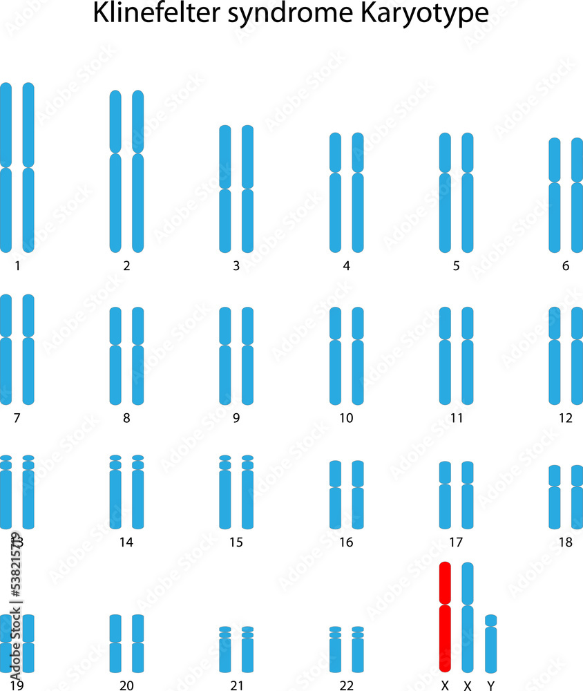 Klinefelter syndrome (XXY) human karyotype Stock Illustration | Adobe Stock