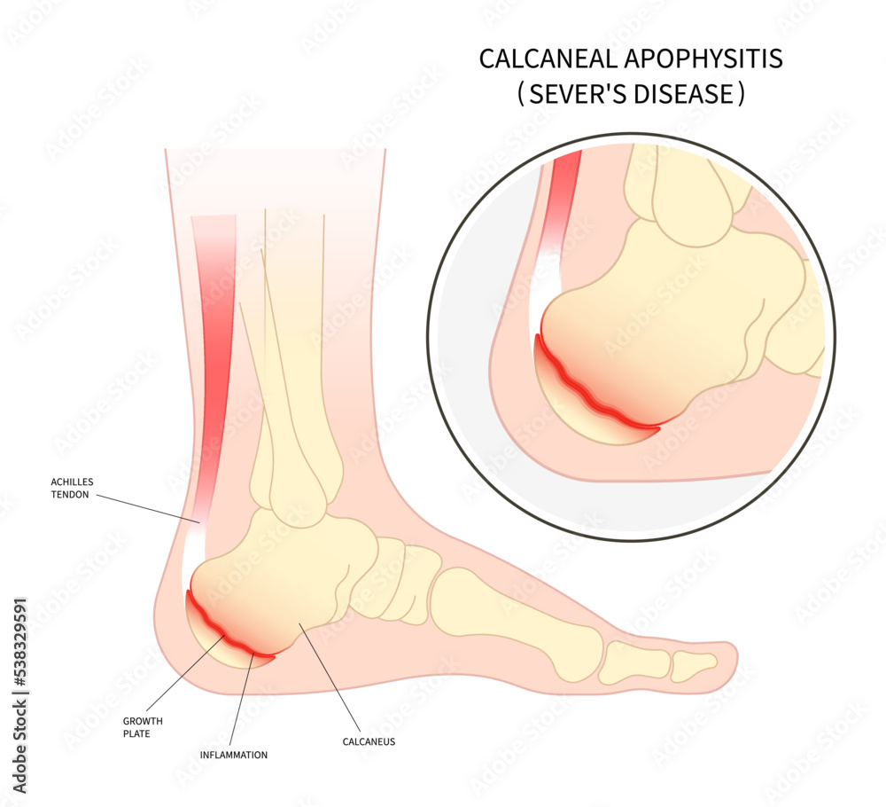 ankle injury broken bone The sever's disease painful tendon tear and haglund's Flatfeet exercise ...