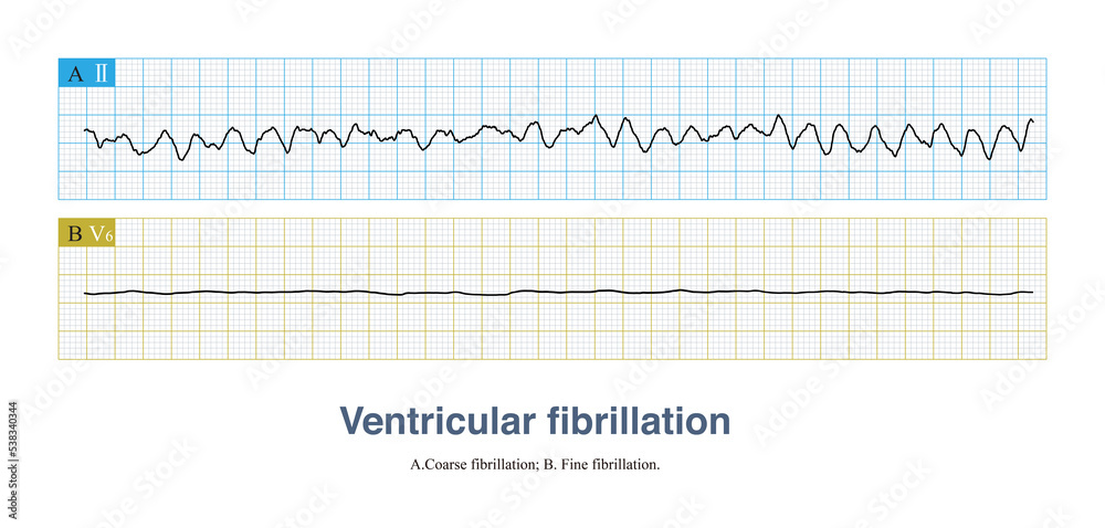 Fine Ventricular Fibrillation Vs Coarse Ventricular Fibrillation