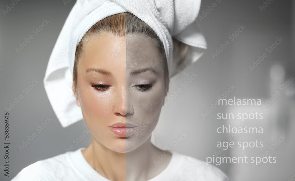 Dark spots, freckles,hyperpigmentation(melasma or chloasma),concept ...