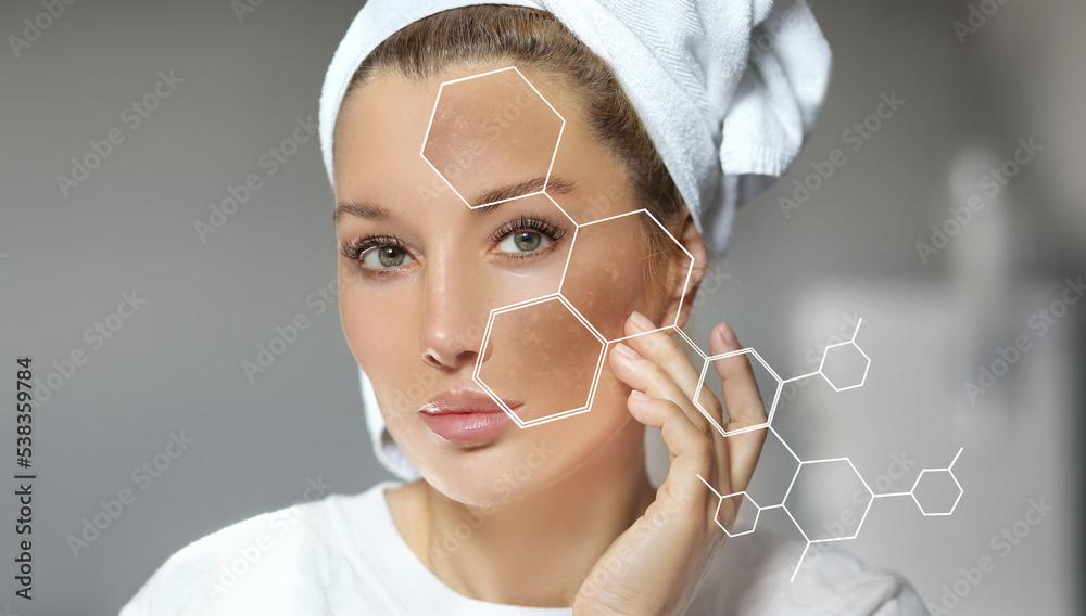 Dark spots, freckles,hyperpigmentation(melasma or chloasma),concept ...
