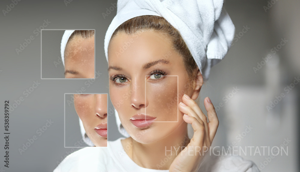 Dark spots, freckles,hyperpigmentation(melasma or chloasma),concept ...