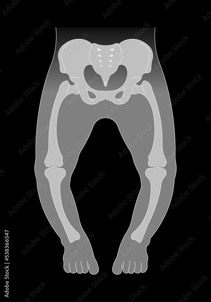 The rickets Blount's and Paget's disease of hip low density lack ...