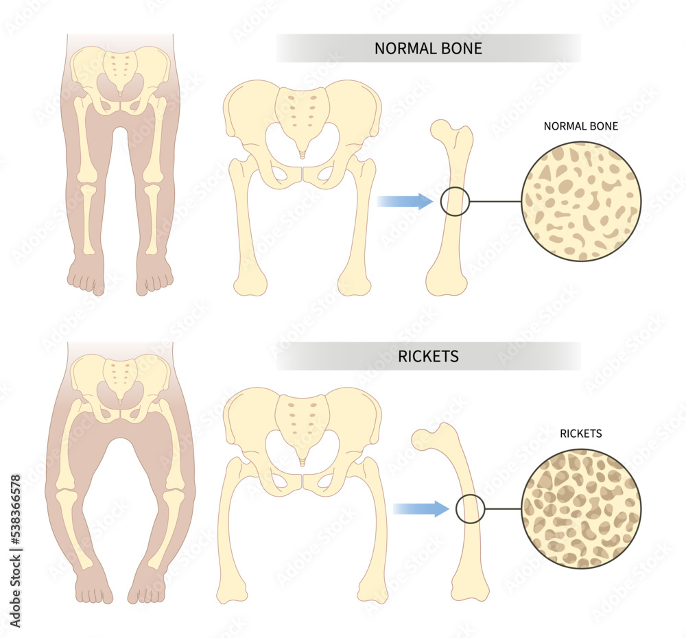 Fracture bone is rickets with x-ray hip low lack of vitamin D and ...