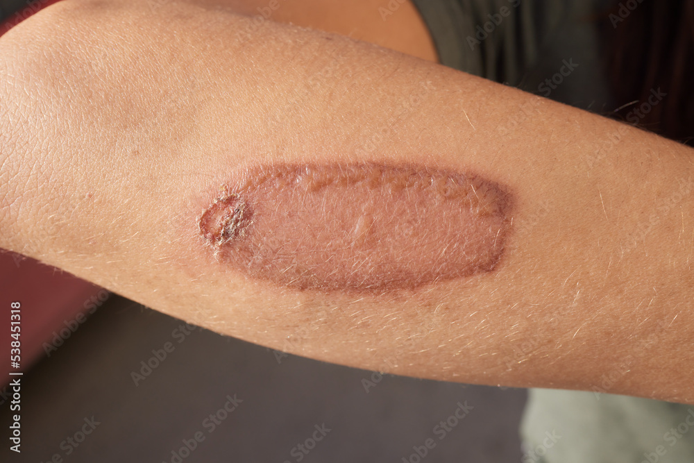 Cut wound on arm and a chemical burn from hydrogen peroxide. Close up ...