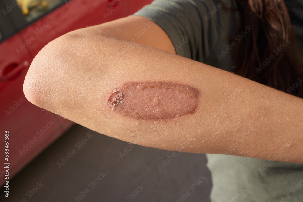 Cut wound on arm and a chemical burn from hydrogen peroxide. Close up ...