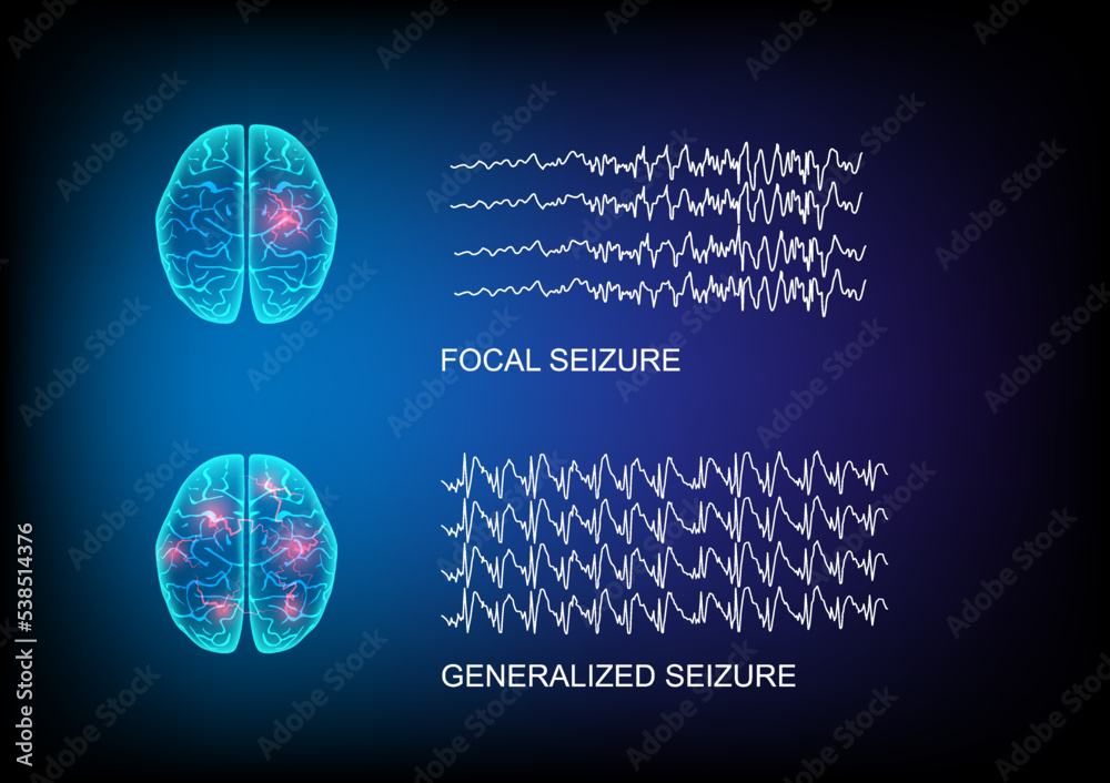 Illustration of seizure types demonstrating by onset and brain waves ...