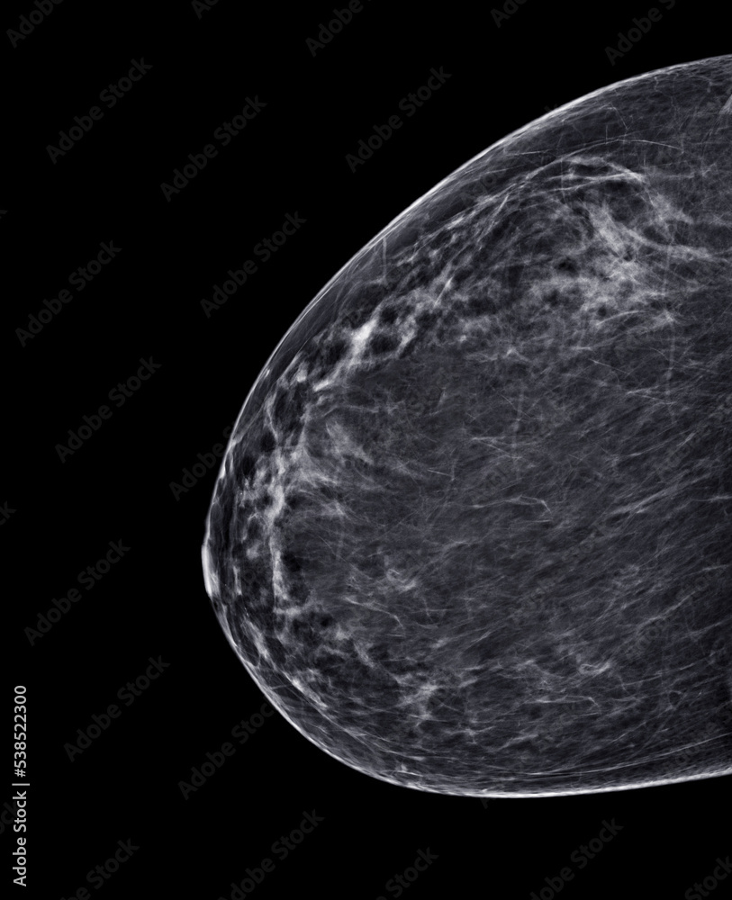 X Ray Digital Mammogram Or Mammography Of Both Side Breast Standard