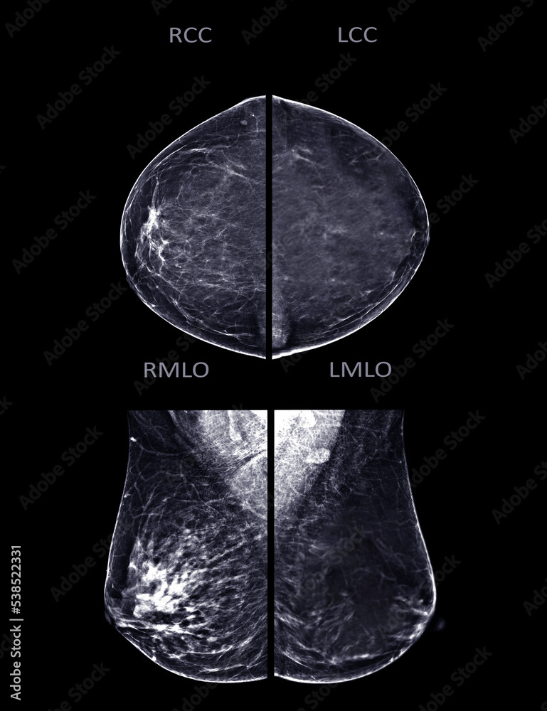 X-ray Digital Mammogram or mammography of both side breast CC view and ...