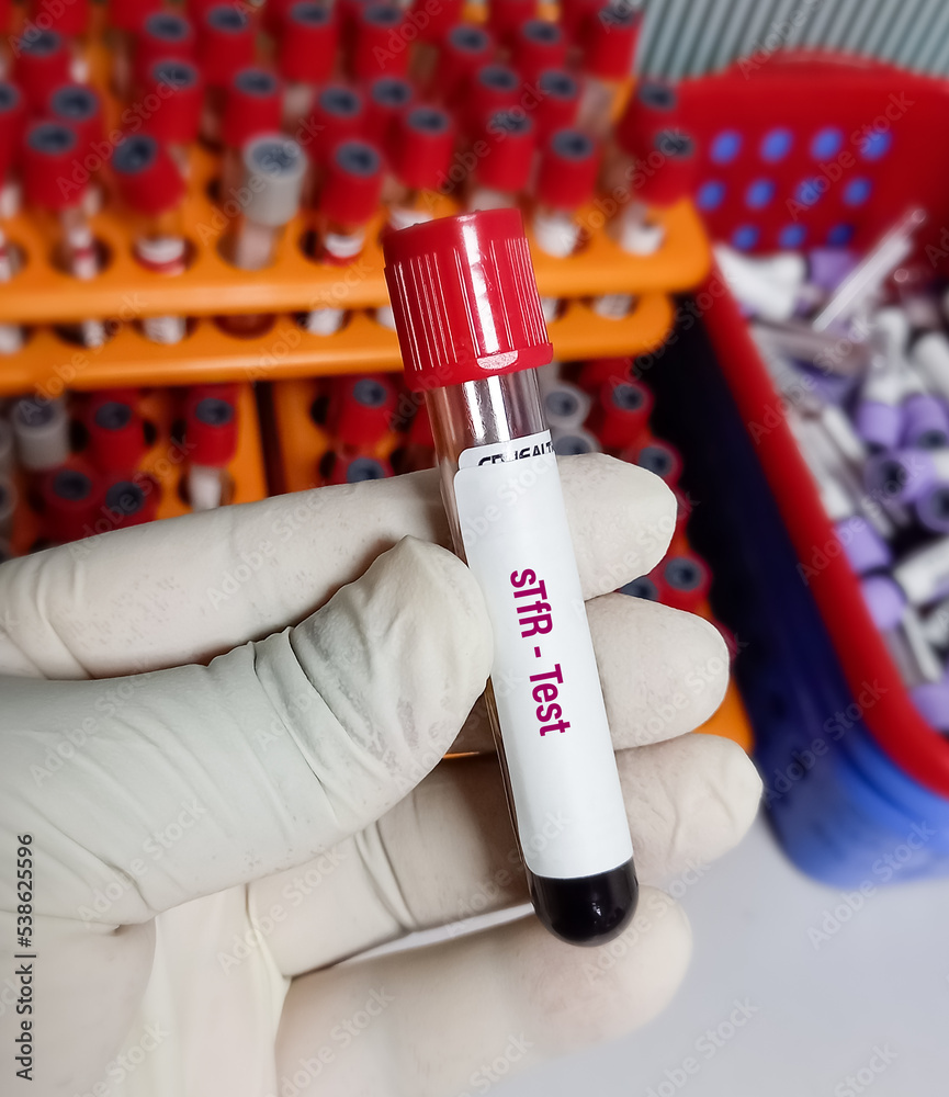Blood samples for sTfR(Soluble transferrin receptor) test. to detect ...